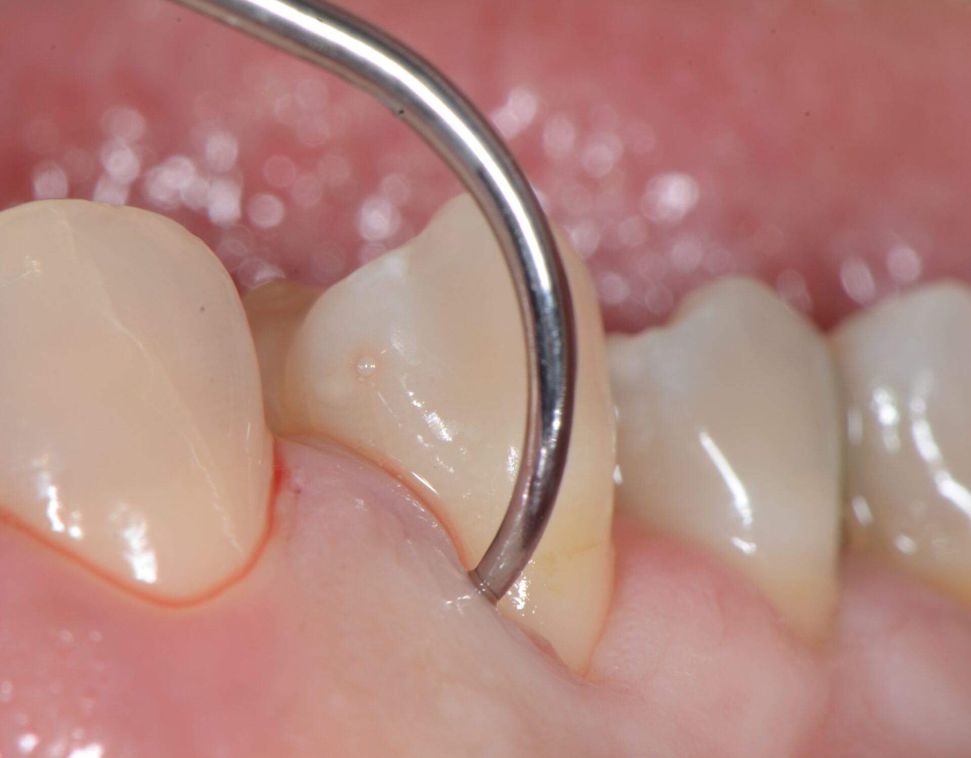 Curettage: che cos’è e perché è obsoleto? - Studio Dentistico Nizzoli ...